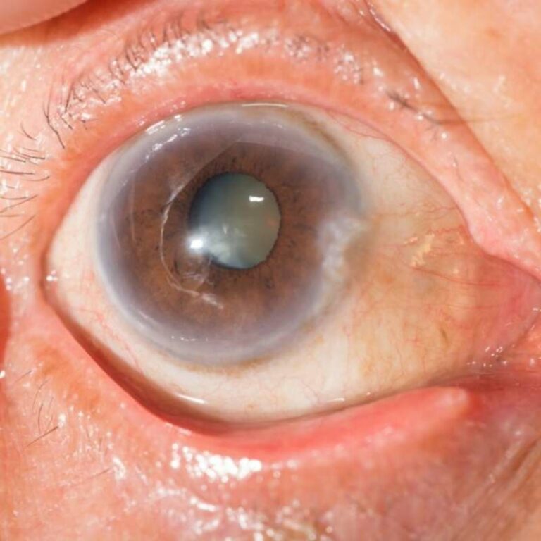 What Are Cataracts? | Cataracts Symptoms & Treatment